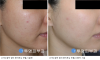 색소침착 잡티 화이트닝 잔털제거 30대 여성10회차 시술 역삼역 피부과 투명피부과 네이버 블로그